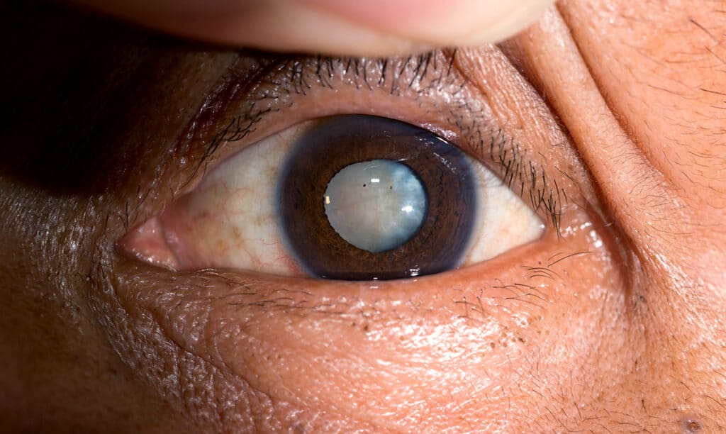Goodbye Cataracts You Can Now Get Rid Of Cataracts Without Using Goodbye Cataracts You Can Now Get Rid Of Cataracts Without Using