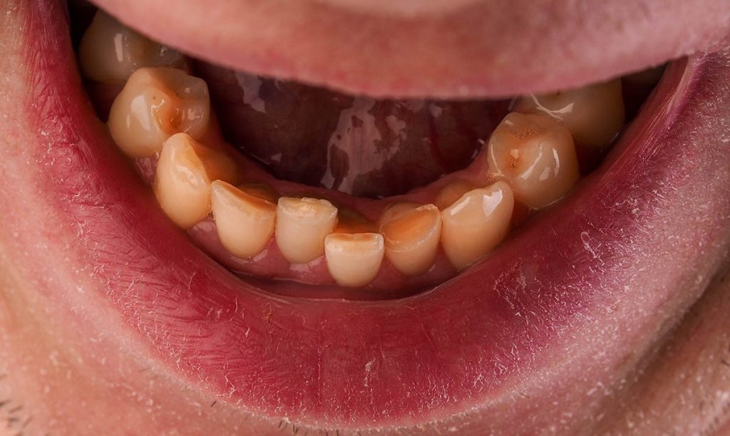 Men Aren’t Brushing Their Teeth And It’s a Problem, According to a ...