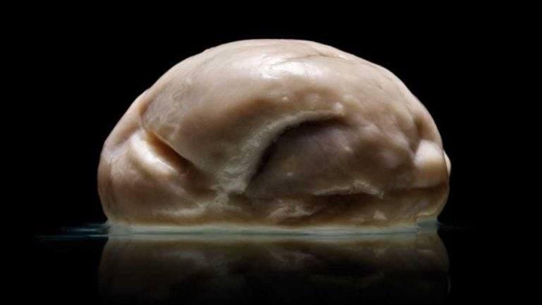 Strange Human Brain With No Wrinkles Found, Baffling People Everywhere ...