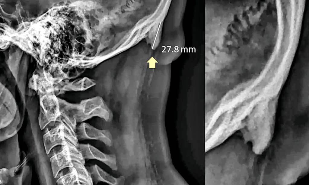 Horns Growing On The Skulls Of The Young, Research Suggest Phones To ...